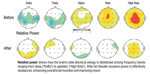 Learning About Nexalin | Wellspring Integrative Neurotherapy